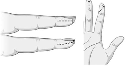 Infecciones de mano. Parte 1: generalidades e infecciones superficiales ...