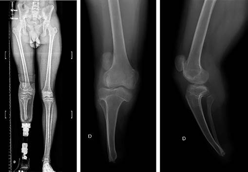 Distal realignment and medial patellofemoral complex reconstruction for ...