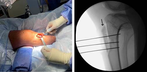 Distal realignment and medial patellofemoral complex reconstruction for ...