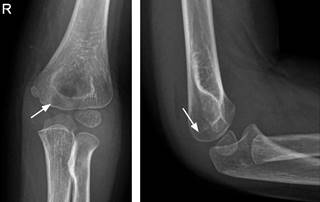 Elbow osteomyelitis by Candida tropicalis in acute lymphoblastic ...