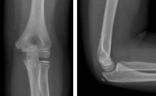 Elbow osteomyelitis by Candida tropicalis in acute lymphoblastic ...