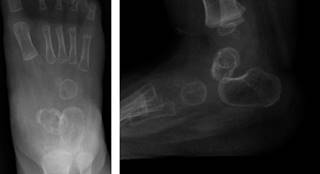 Osteomyelitis of the talus in infants following Bacillus Calmette ...