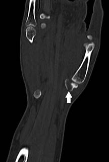 Trapezius and hamate body fractures. Case report of a rare association
