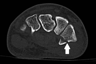 Trapezius and hamate body fractures. Case report of a rare association