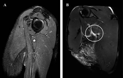 Teres major rupture: case report in a jiu-jitsu athlete