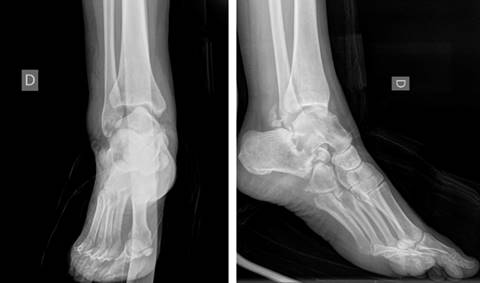 Fractura-luxación subastragalina lateral irreductible por interposición ...