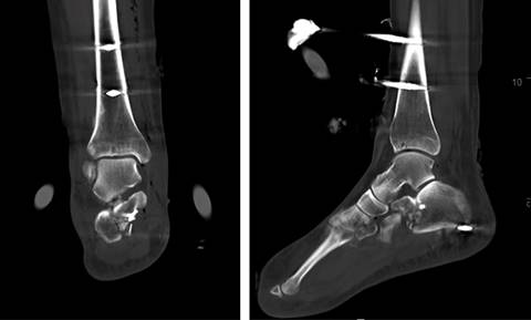 Fractura-luxación subastragalina lateral irreductible por interposición ...