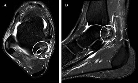 Medial Tubercle Of Talus Fracture