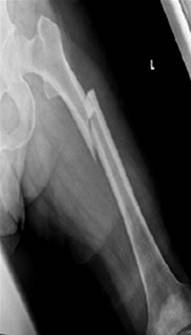 Bilateral atypical femoral fractures caused by long-term use of ...