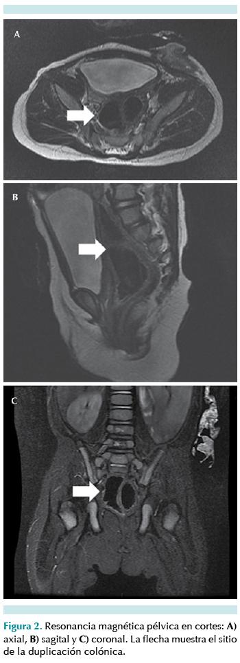 Asociación de malformación anorrectal con duplicaciones anales y rectales