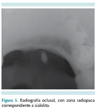 Sialolitiasis submandibular en un paciente pediátrico: Reporte de caso