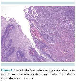 Fascitis necrosante secundaria a onfalitis en un recién nacido con ...