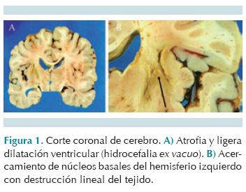 Preescolar masculino con Síndrome Prader-Willi y tromboembolia pulmonar