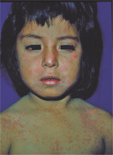 Exantemas en pediatría