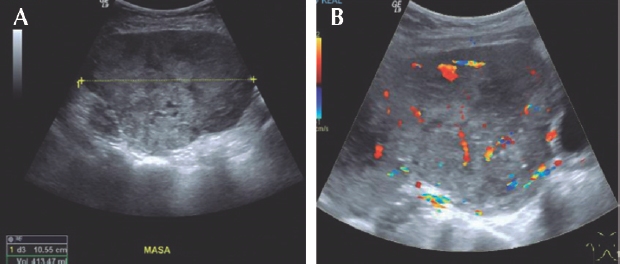 Tumor germinal mixto con componentes de disgerminoma y coriocarcinoma ...