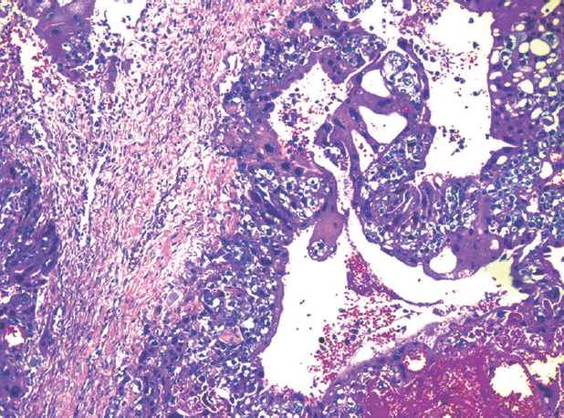Tumor germinal mixto con componentes de disgerminoma y coriocarcinoma ...