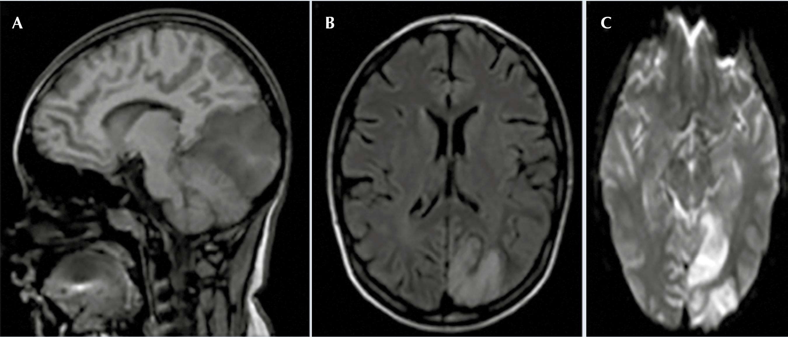 Mutación m.3271T>C del gen MT-TL1 en encefalopatía mitocondrial ...