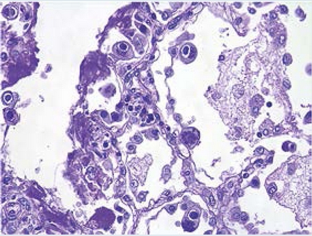 Ependimoma celular parcialmente resecado complicado con ...