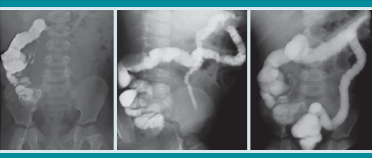 Realimentación por estoma distal en una serie de casos de niños con ...