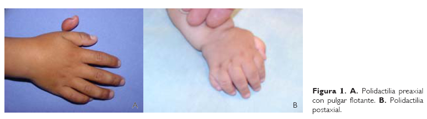 Experiencia con polidactilia preaxial en el Instituto Nacional de Pediatría