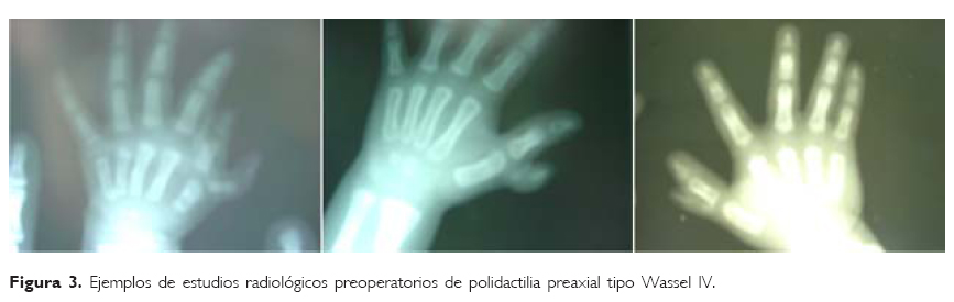 Experiencia con polidactilia preaxial en el Instituto Nacional de Pediatría