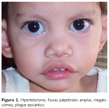 Síndrome de Neuhauser: megalocórnea, retardo mental e hipotonía