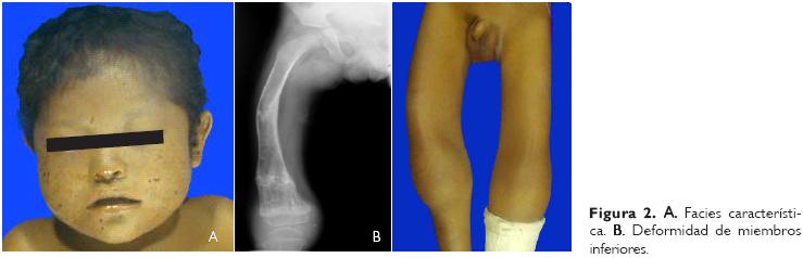 Síndrome de Alagille: una causa de colestasis intrahepática persistente