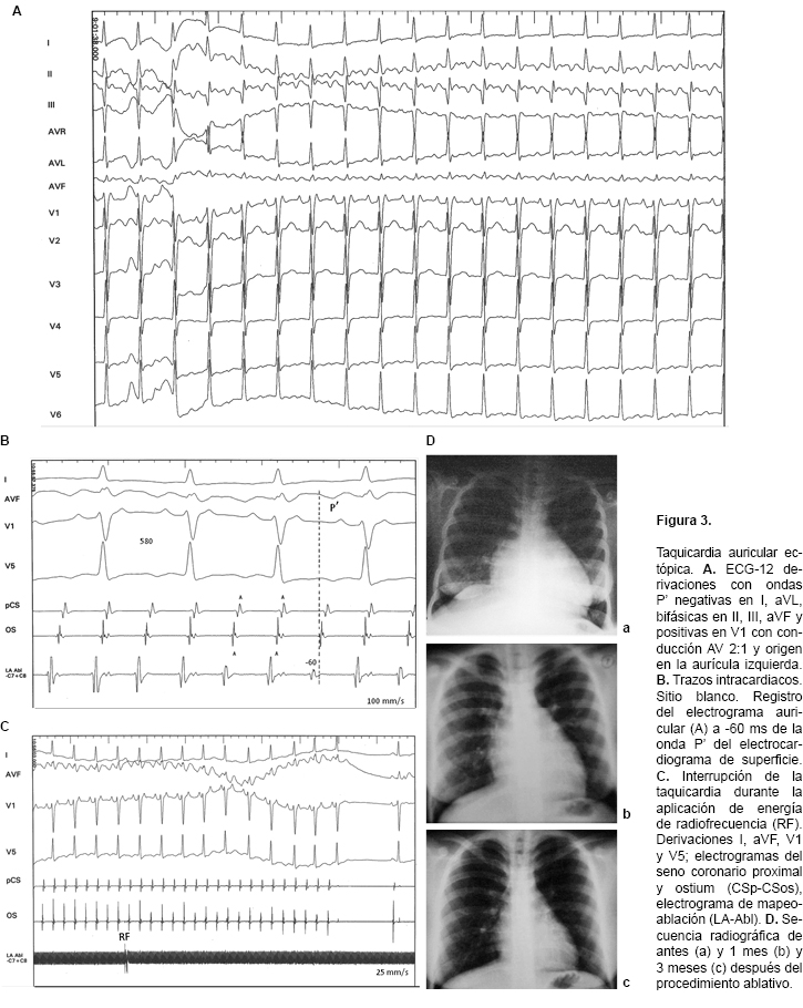 Cardiomiopatía inducida por taquicardia en niños y adolescentes