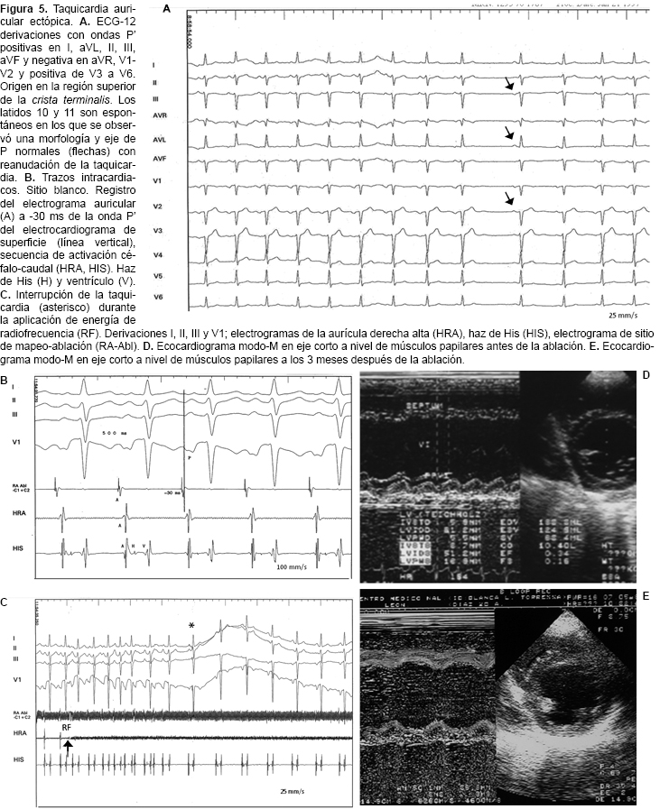 Cardiomiopatía inducida por taquicardia en niños y adolescentes