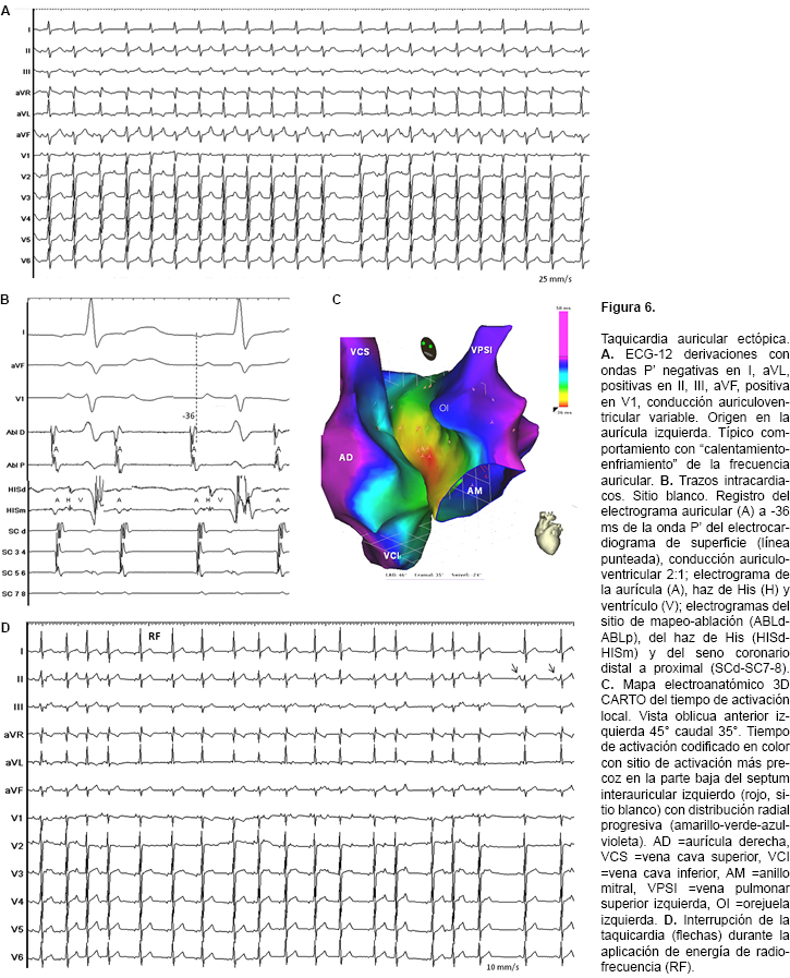 Cardiomiopatía inducida por taquicardia en niños y adolescentes