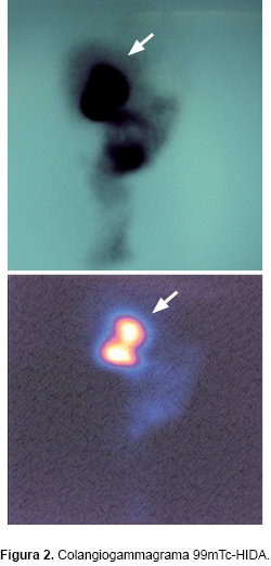 Quiste de colédoco tipo I: Diagnóstico por imagen y anastomosis ...