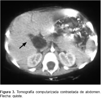 Quiste de colédoco tipo I: Diagnóstico por imagen y anastomosis ...