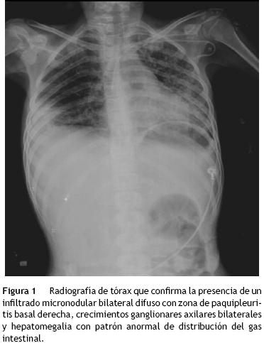 Tuberculosis miliar: la reemergencia de enfermedades y la falta de ...