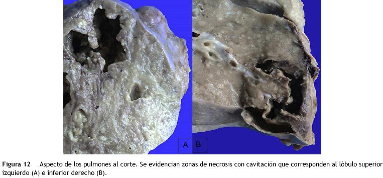 Tuberculosis miliar: la reemergencia de enfermedades y la falta de ...