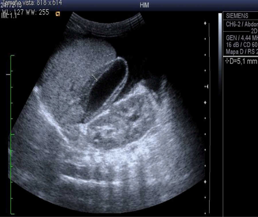 Lactante con ictericia progresiva, cirrosis y tubulopatía proximal