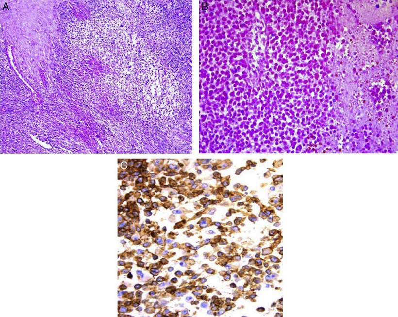 Sarcoma de Ewing extraóseo en una adolescente de 16 años