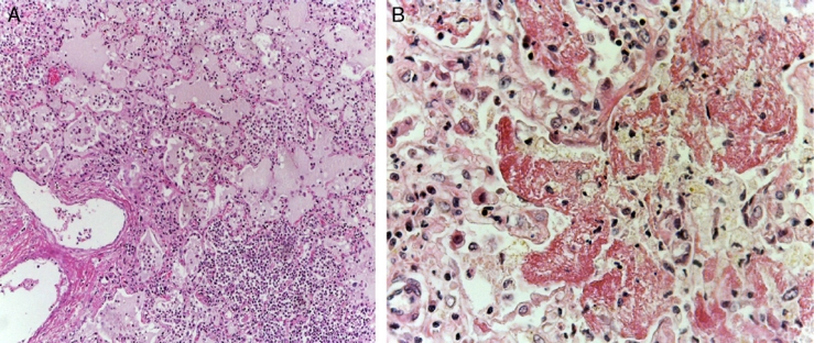 Glioblastoma del puente. Gliomas pediátricos en la clasificación actual ...
