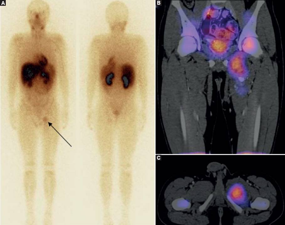 Evaluación de la recurrencia de tumores musculoesqueléticos mediante ...