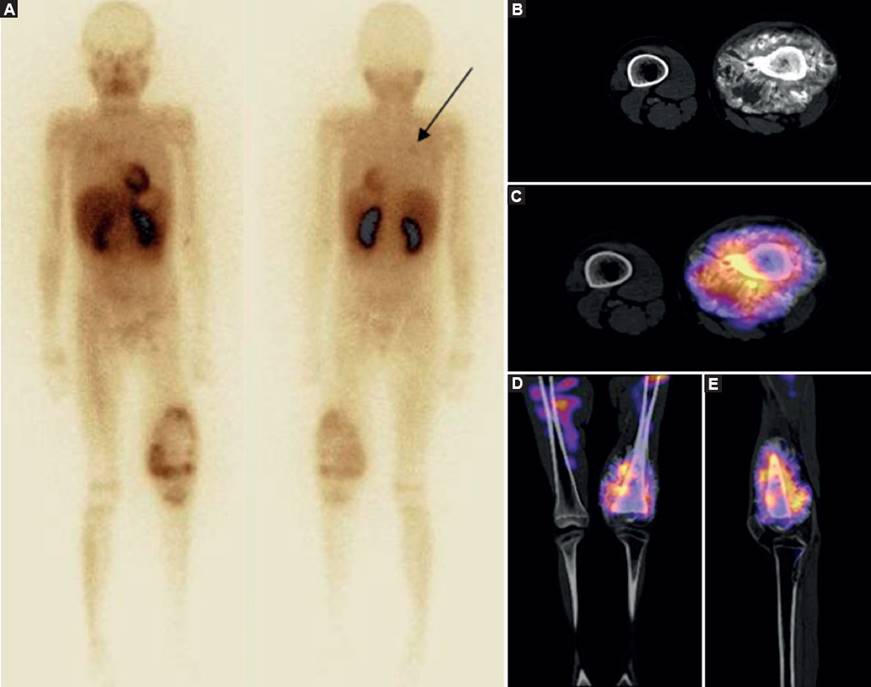 Evaluación de la recurrencia de tumores musculoesqueléticos mediante ...