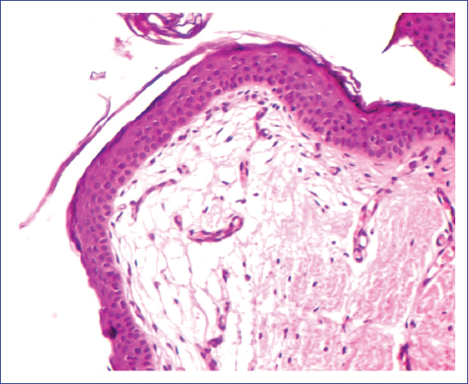 Hipoplasia dérmica focal (síndrome de Goltz)