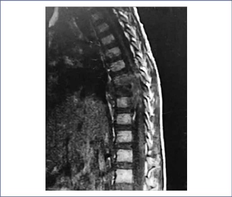 Histiocitosis de células de Langerhans con compromiso vertebral