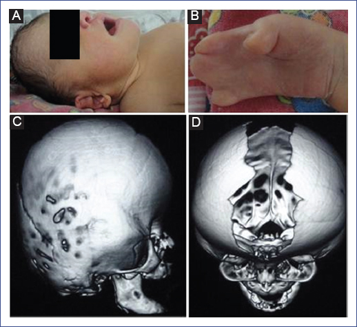Clinical and genetic findings of two cases with Apert syndrome
