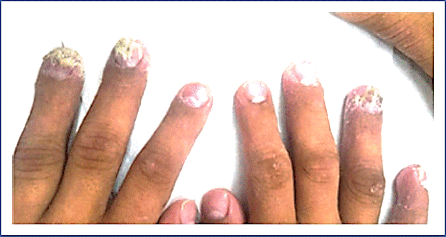 Escabiasis costrosa imitando una acrodermatitis continua de Hallopeau