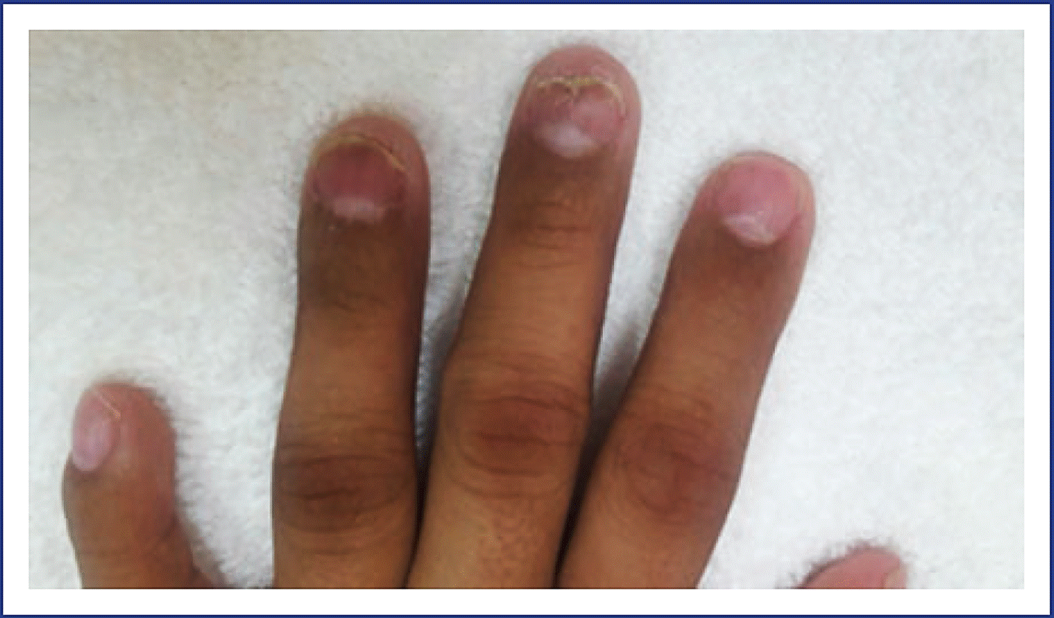 Escabiasis costrosa imitando una acrodermatitis continua de Hallopeau