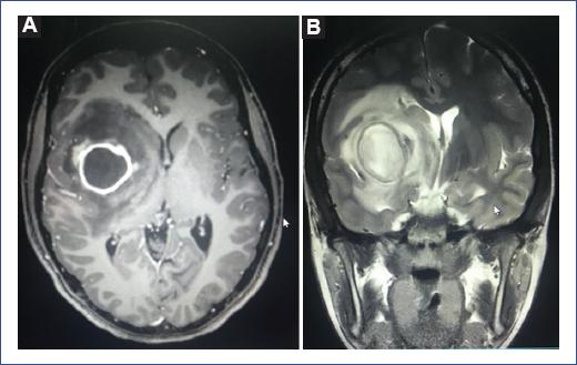 Absceso cerebral por Eikenella corrodens en un paciente pediátrico ...