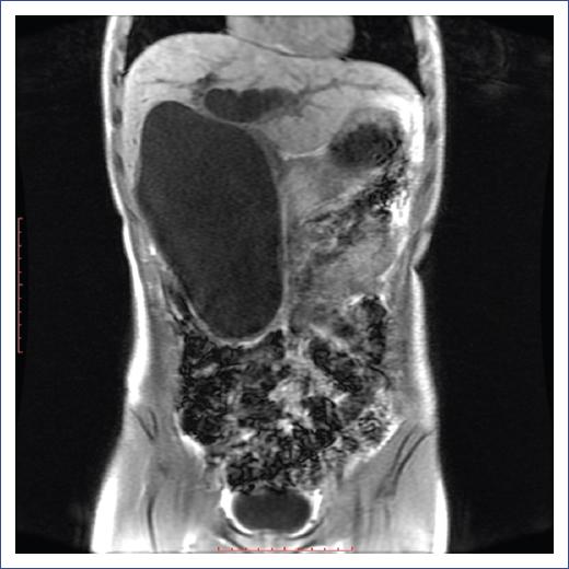 Tratamiento laparoscópico de un quiste de colédoco gigante en un ...