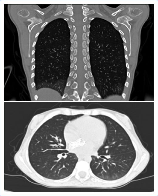 Pulmonary involvement in patients with juvenile systemic sclerosis