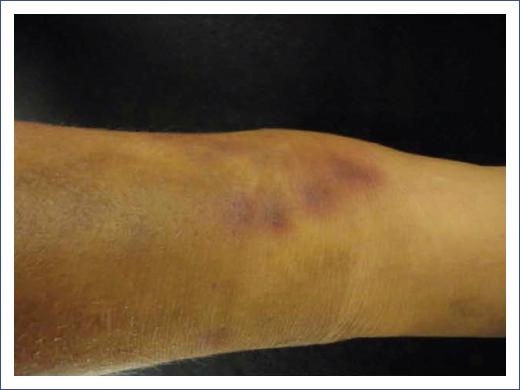 Leukemia cutis and other dermatological findings in pediatric patients ...