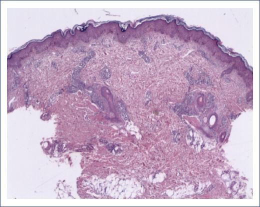 Leukemia cutis and other dermatological findings in pediatric patients ...