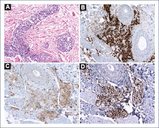 Leukemia cutis and other dermatological findings in pediatric patients ...